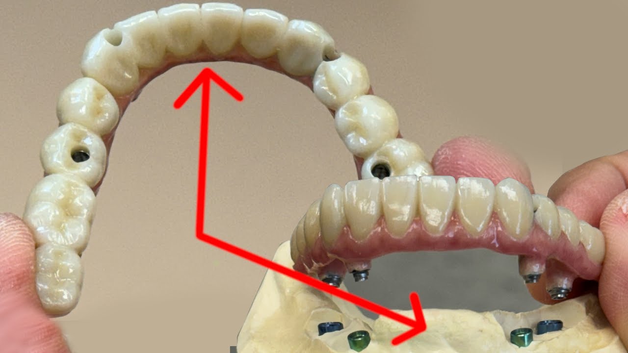 SOLVED: Thin Bridge for Long-Span Pontic Case - YouTube