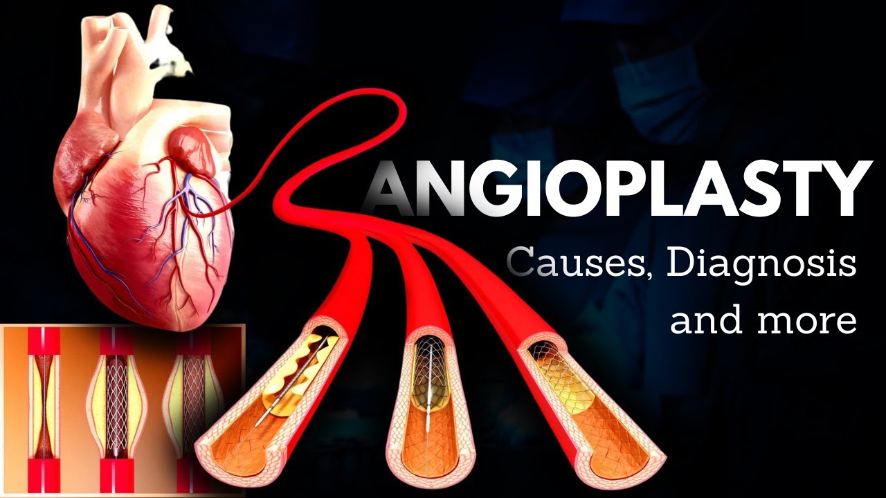 Angioplasty, Causes, Signs and Symptoms, Diagnosis and Treatment. - YouTube