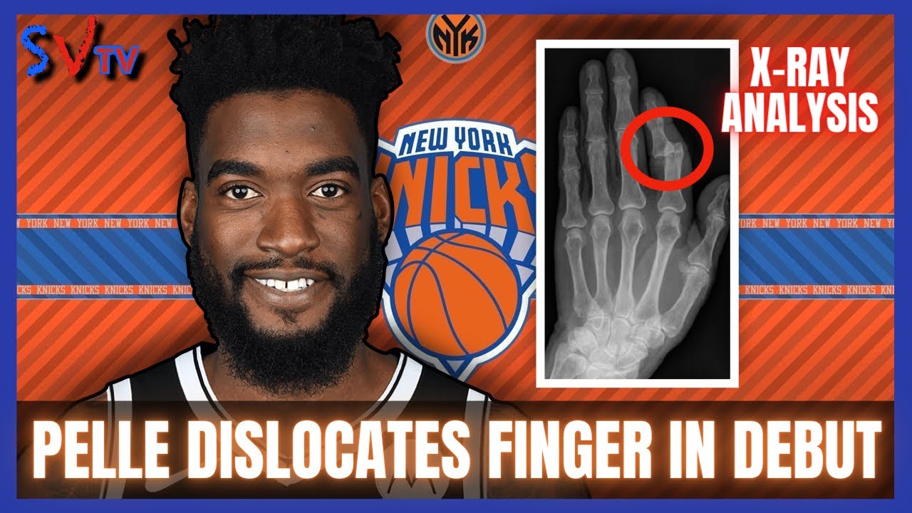 Knicks' Norvel Pelle Dislocates Finger! | Knicks Injury Update: XRAY ...