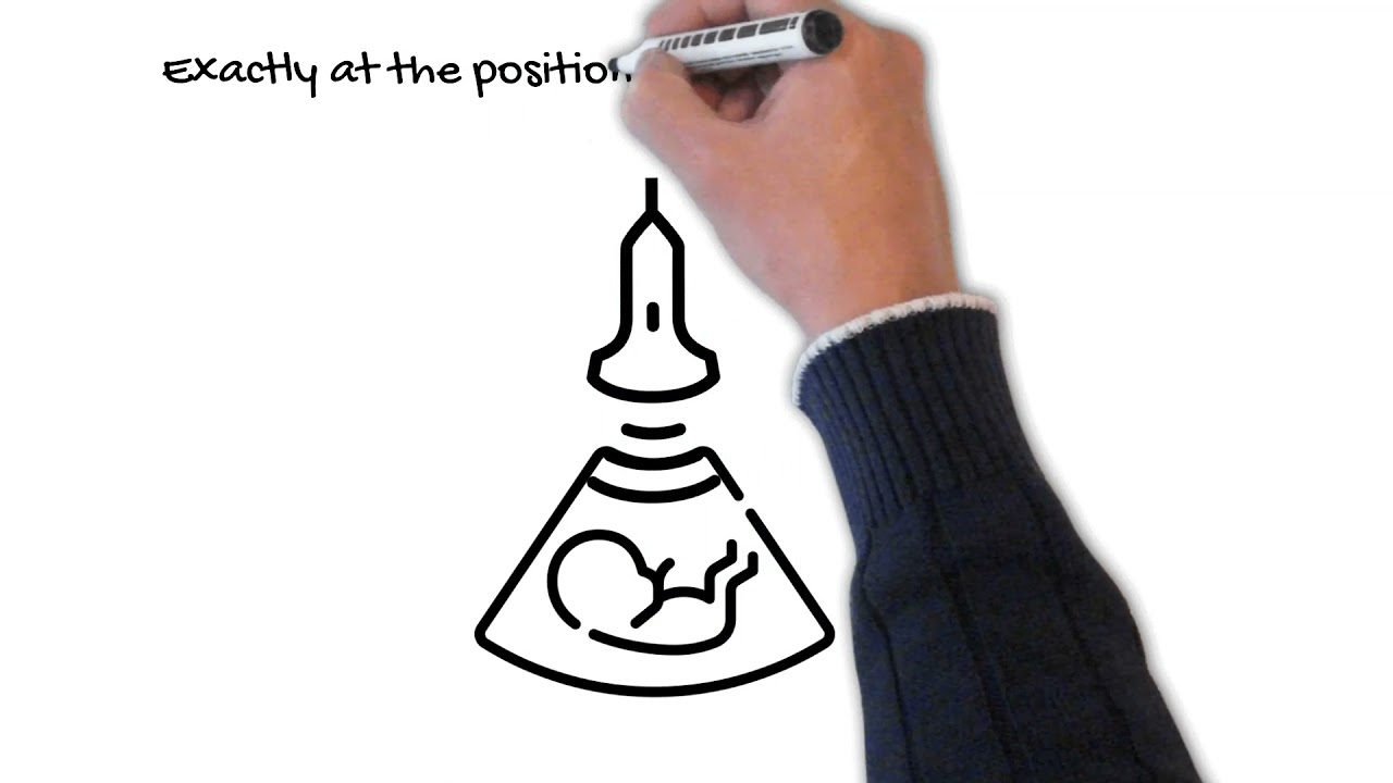 SonoXR - Augmented Reality Ultrasound for diagnosis and intervention ...