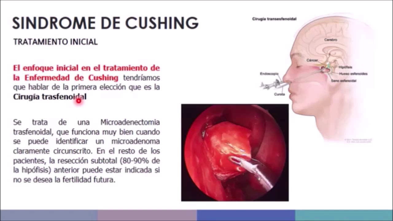 Caso Clínico #088 - Enfermedad de Cushing - YouTube