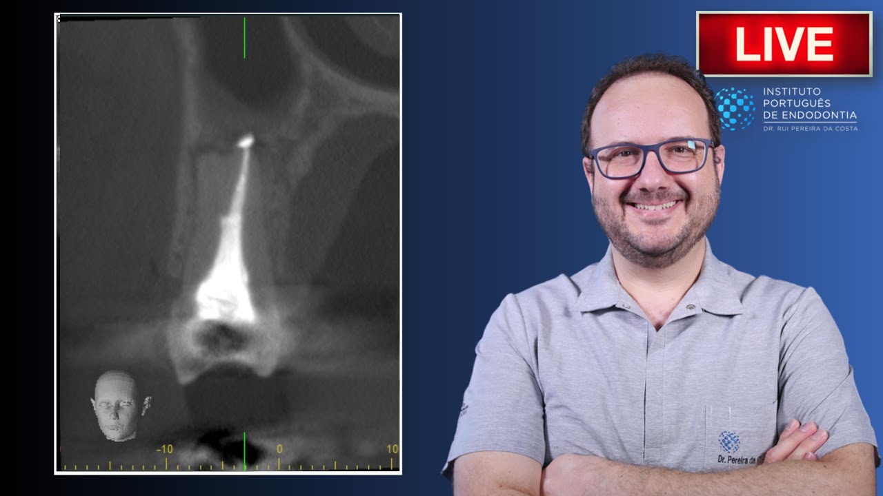 RTx of 🦷15 Vertucci Type 5 with Missed Anatomy ️ Part 1 | CASE171 - YouTube