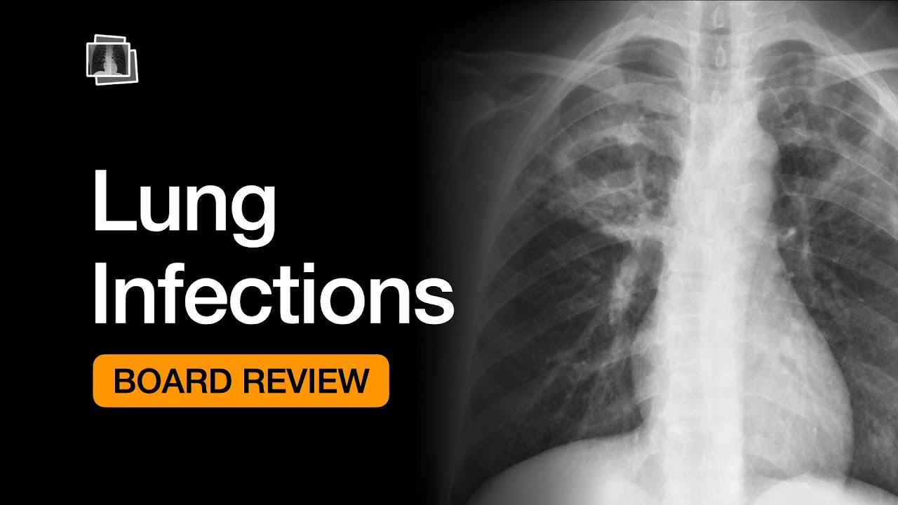 Lung Infections | Chest Radiology Board Review - YouTube