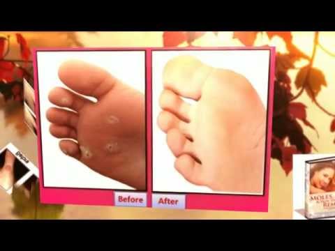 How To Get Rid Of Warts - The Fast 3 How To Get Rid Of Warts Tips - YouTube