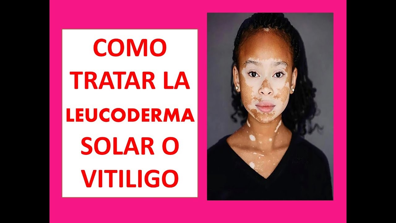 SOLUCIÓN efectiva 😎 COMO tratar LEUCODERMIA SOLAR O VITILIGO 💣 BORRAR ...