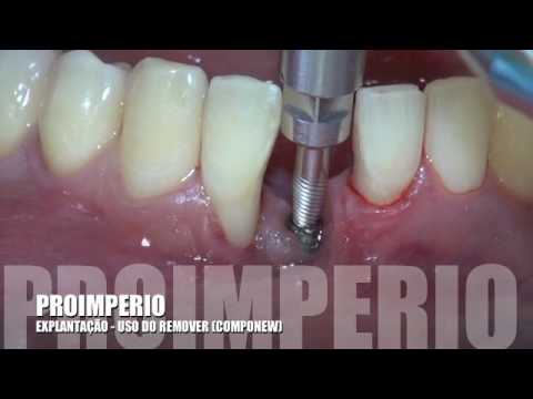 Remover - Chave Removedora de Implantes Osseointegrados com Torque ...