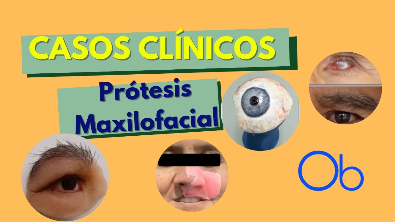 CASOS CLÍNICOS DE PRÓTESIS MAXILOFACIAL - YouTube