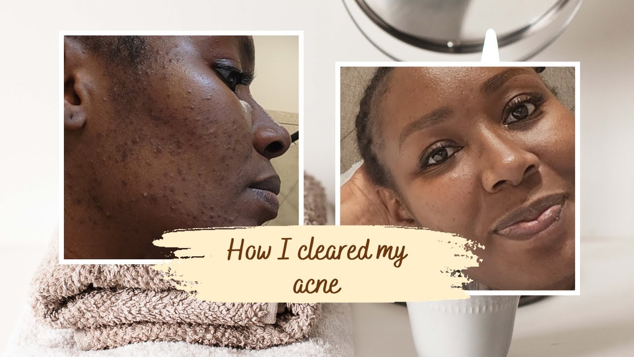 Clearing Up Acne | The Ultimate Guide to flawless skin | Clear Scars ...