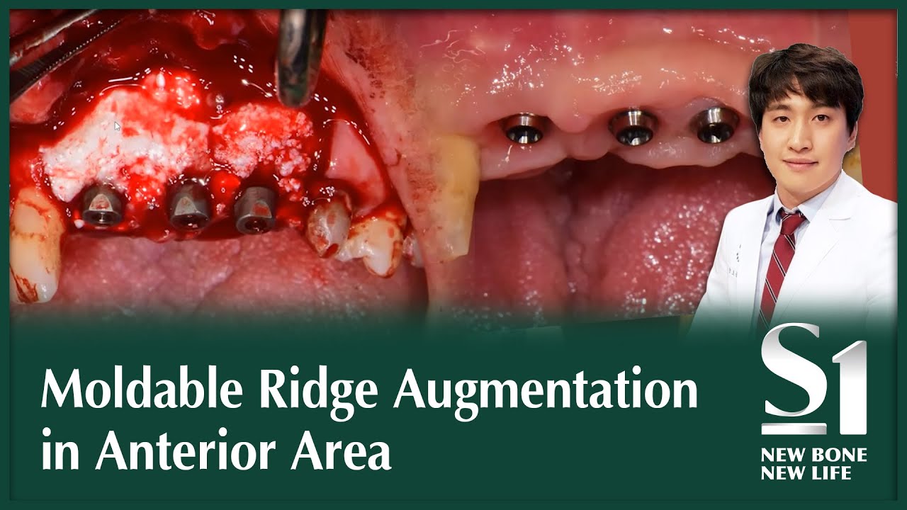 [SUB] S1, Moldable Ridge Augmentation in Anterior Area - YouTube