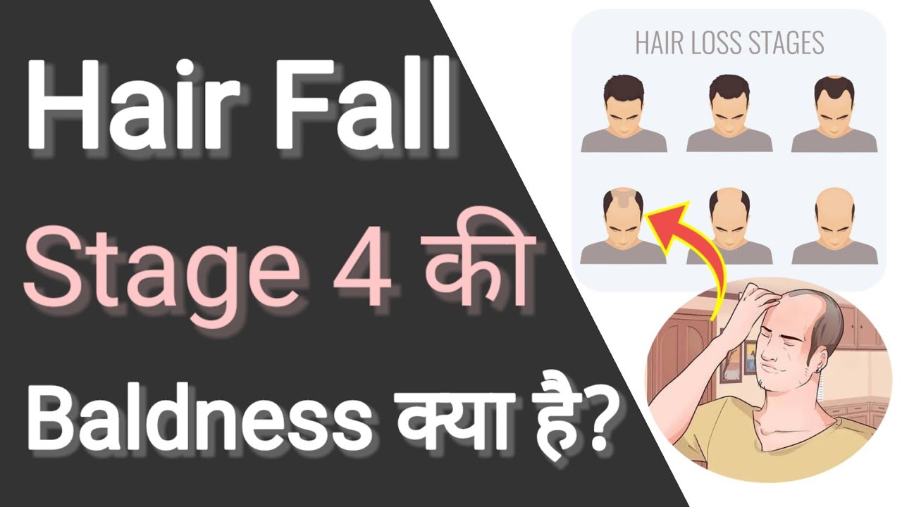 Hair Fall Stage 4 Baldness क्या है? | Hair Baldness | Hair Transplant ...