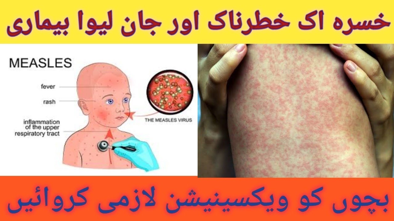 Khasra ki Alamat or Khasra ka ilaj | Measles the Dangrous infection ...
