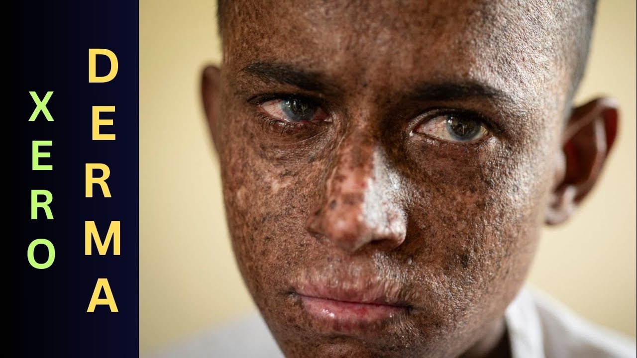 Glowing In The Dark: The Rare Condition Of Xeroderma Pigmentosum - YouTube