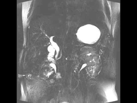 Type I choledochal cyst - YouTube