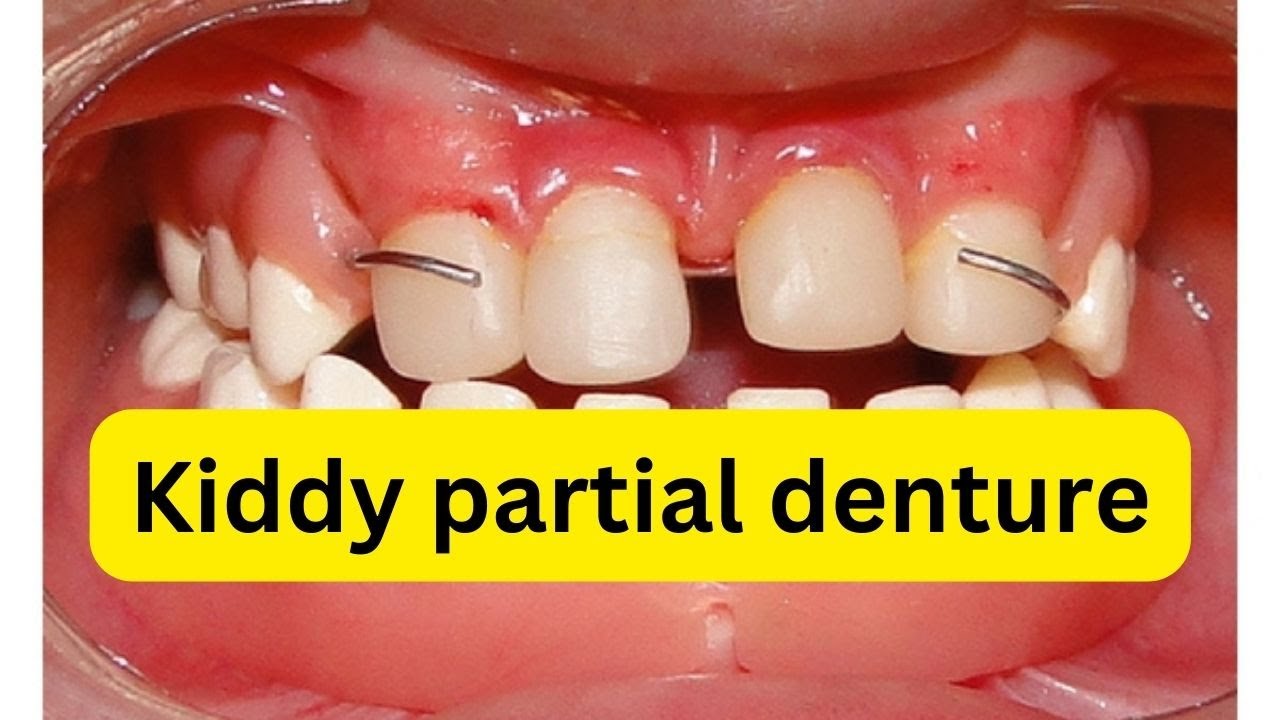 Kiddy partial denture indications (EASY) - YouTube