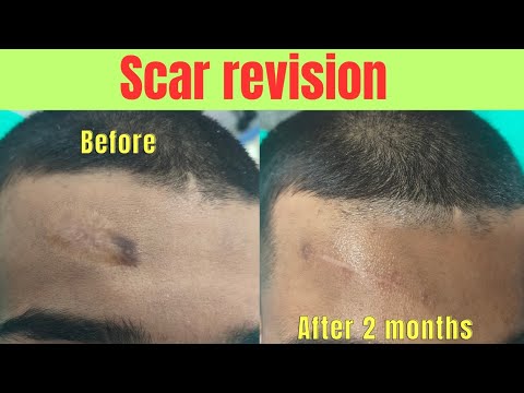 2 month follow up result of scar revision surgery| Forehead scar - 2 ...