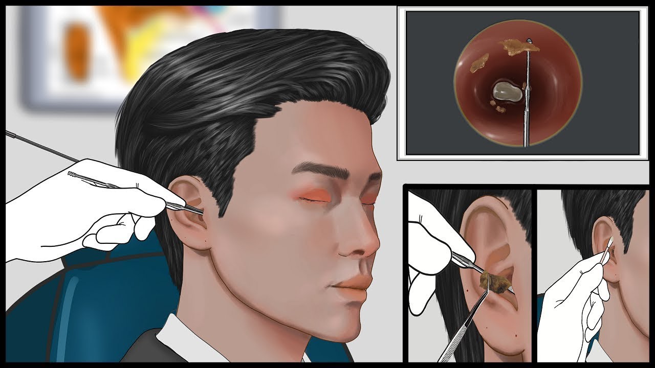 Asmr Ear Cleaning And Earwax Removal Animation 清潔耳部及去除耳蠟動畫 귀 청소 및