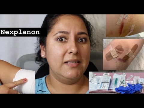 Nexplanon removal and insertion - YouTube