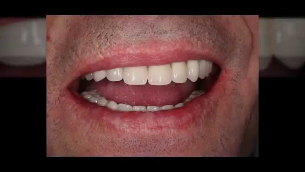 Upper & Lower Dental Implants To Replace Missing Teeth - YouTube