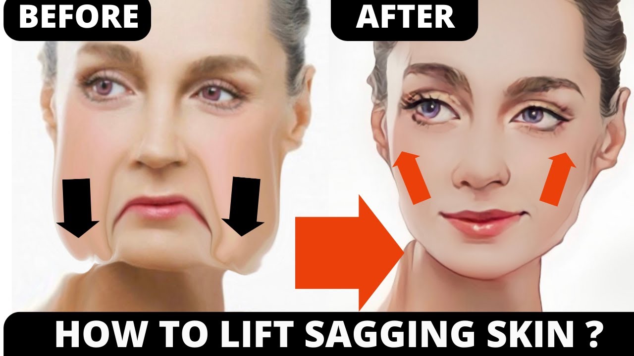 HOW TO LIFT CHEEKS NATURALLY ? SAGGY SKIN, JOWLS, LAUGH LINES ...