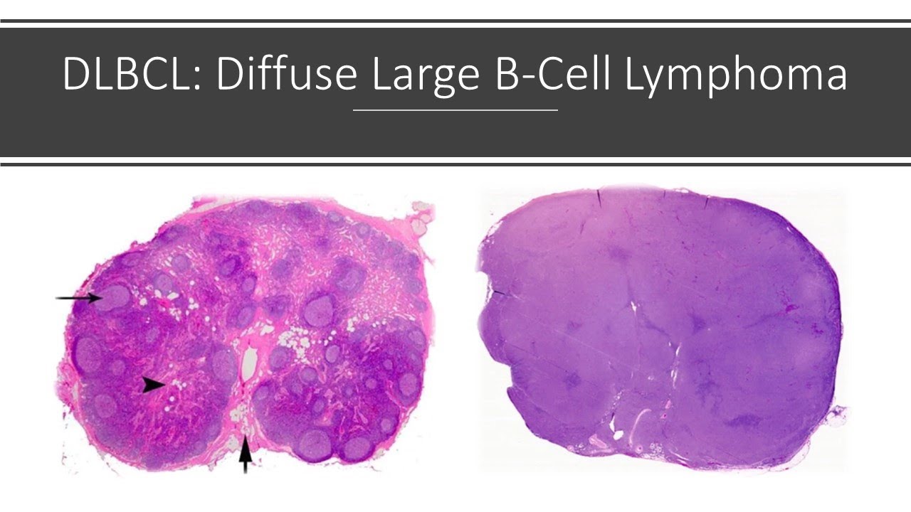 Hallmarks of Cancer: Personal Diffuse Large B-Cell Lymphoma Case Study ...