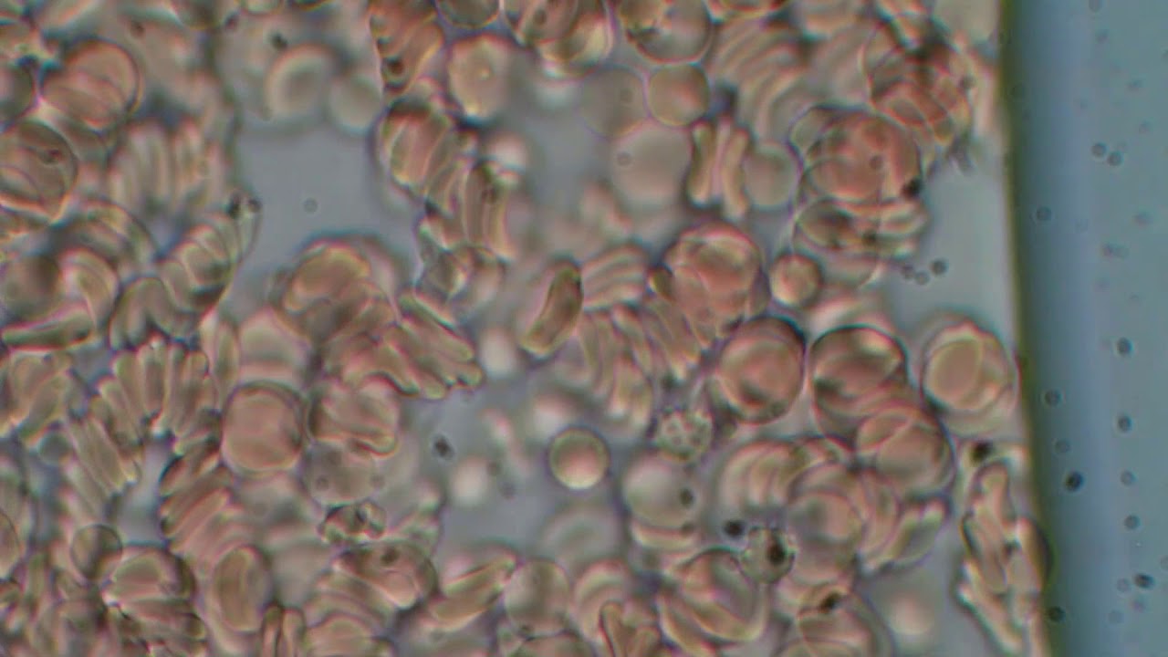 Glóbulos rojos equinocitos - YouTube