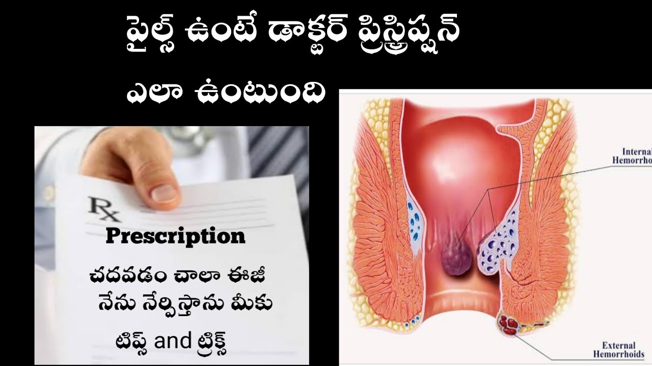 Prescription For Piles Treatment For Piles In Telugu Tablets For prescription-for-piles-treatment-for-piles-in-telugu-tablets-for