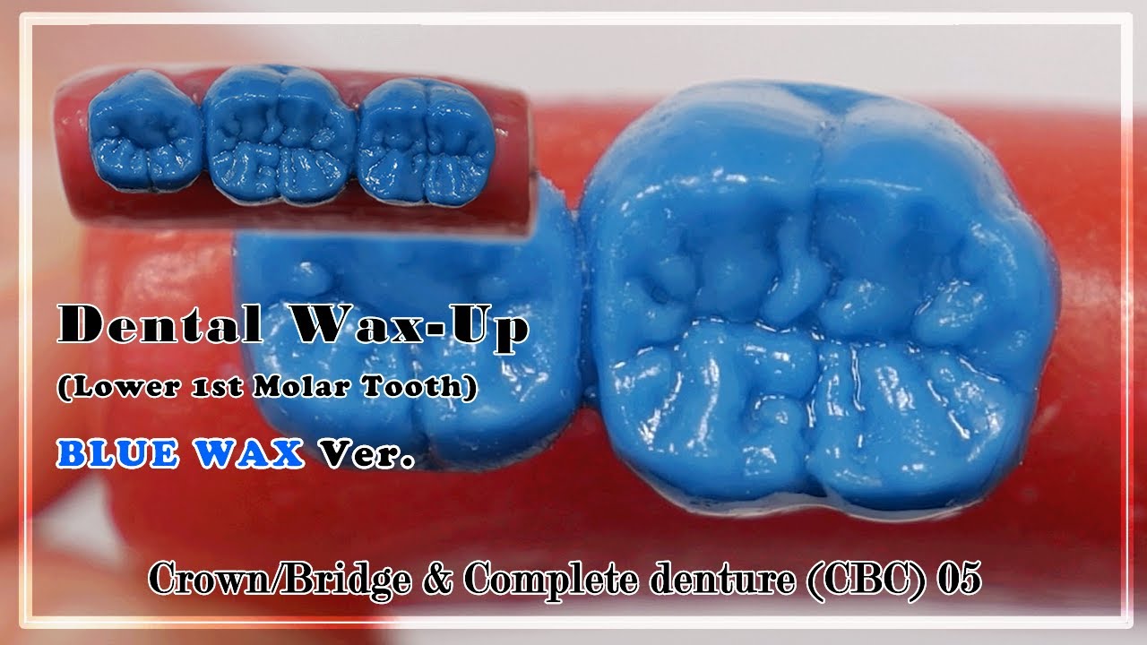 Dental Waxup For Crown/Bridge & Complete denture(CBC) Lower 1st molar ...