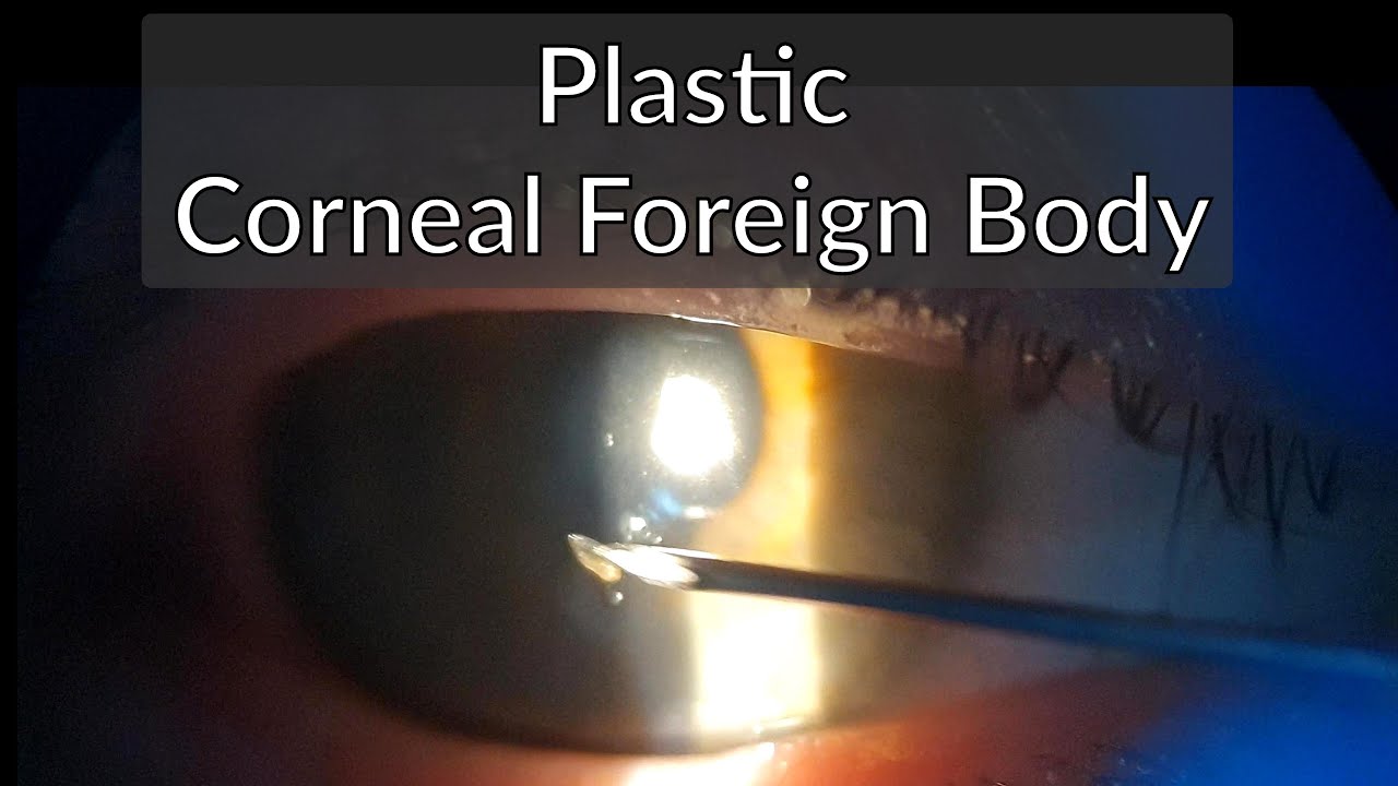 Plastic Corneal Foreign Body Removal with a Needle - YouTube