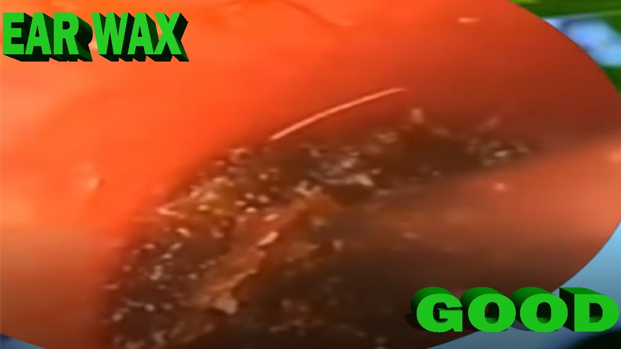 Huge Tonsil Stones Ear wax Removal in a case of Chronic Tonsillitis ...