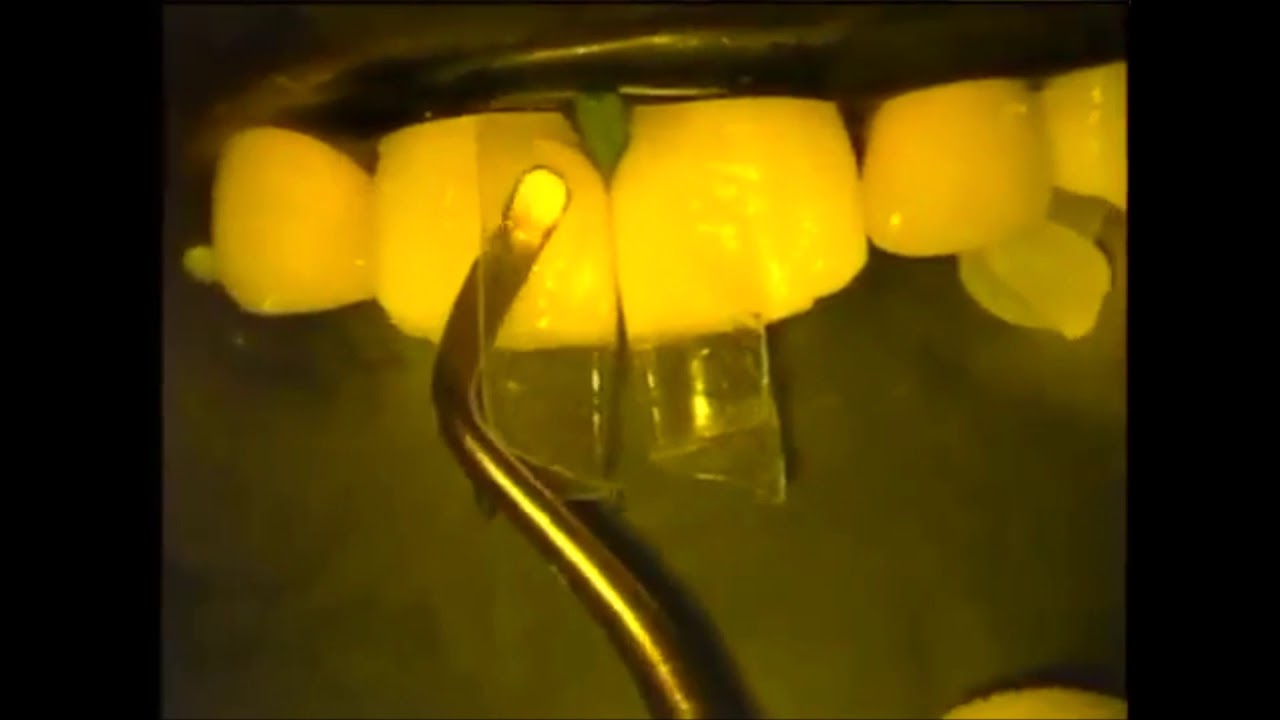 Mid-line Diastema Closure Bioclear Matrix - YouTube