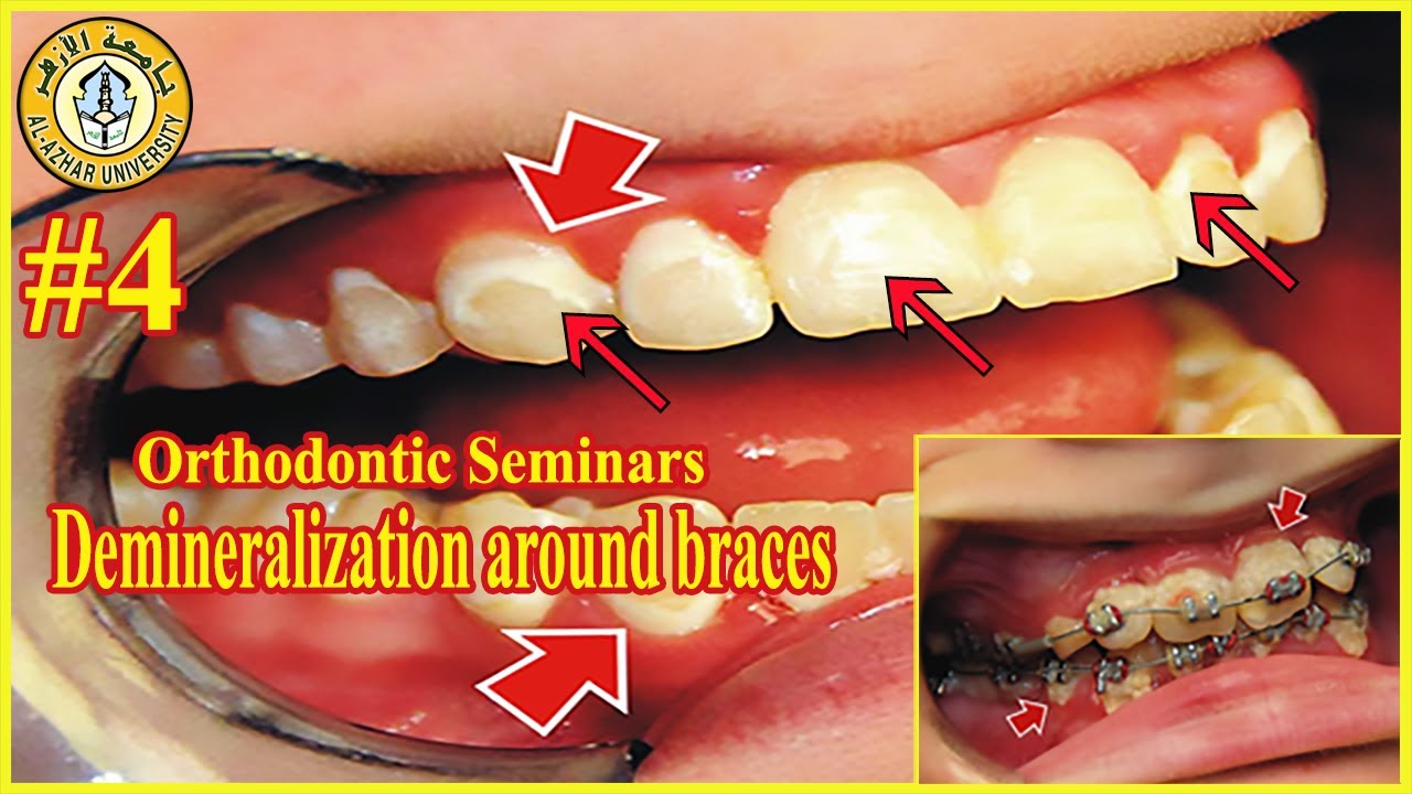 #4 Demineralization around orthodontic braces سيمينارات تقويم الأسنان ...