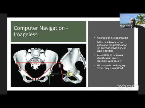 New Technology in Total Hip Replacement - YouTube