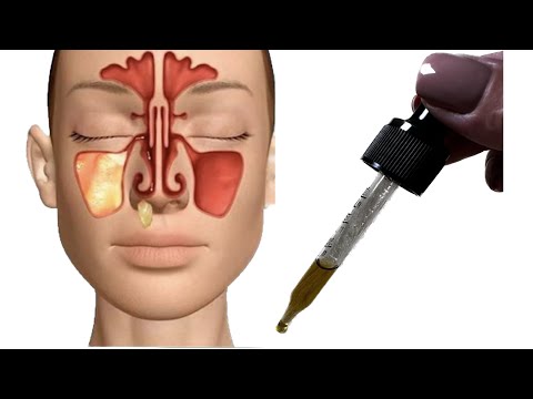 Bu yağı burnunuza koyun ve 3 günde sinüzitten kurtulun.Bronşit ve solunum yollarını temizler.