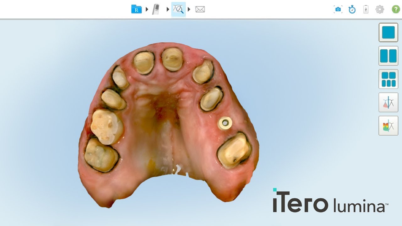 Full arch rehabilitation scan example with iTero Lumina™ intraoral ...