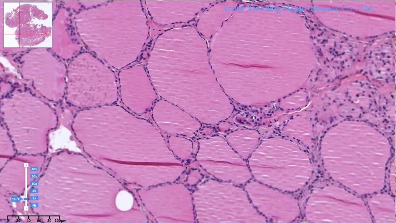 prepared pathology slides of thyroid nodules under microscope scanner ...