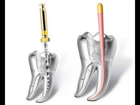 Endodontie | les étapes du traitement endodontique en détail - YouTube