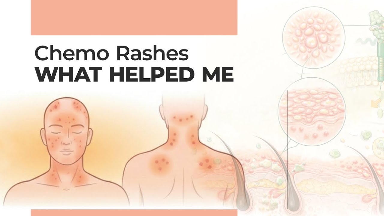 Chemotherapy Rashes: What Actually Helped Me - YouTube
