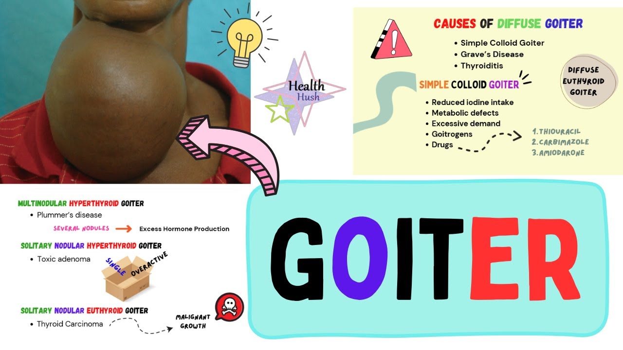Goiter Simplified: Causes, Symptoms, and Types Explained - YouTube