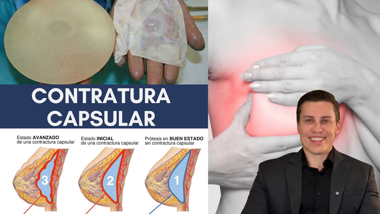 Contratura Capsula | Doença do Silicone - O que é e por que acontece ...