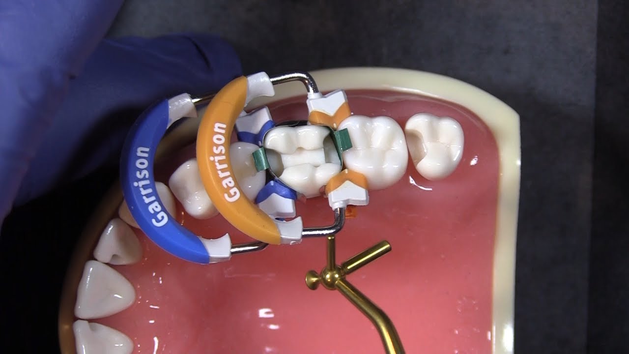 Tofflemire vs. ReelMatrix/AutoMatrix vs. Composi-Tight 3D Fusion ...