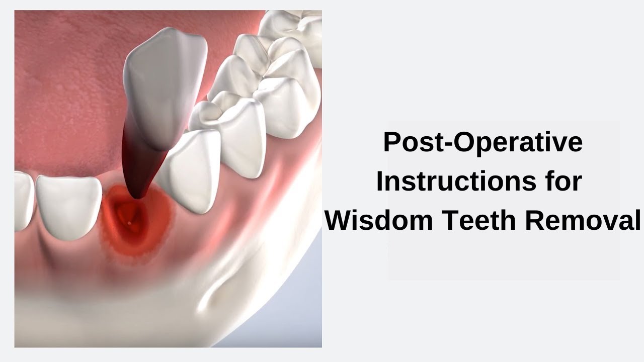 Post-Operative Instructions for Wisdom Teeth Removal by Dr. Rohit ...