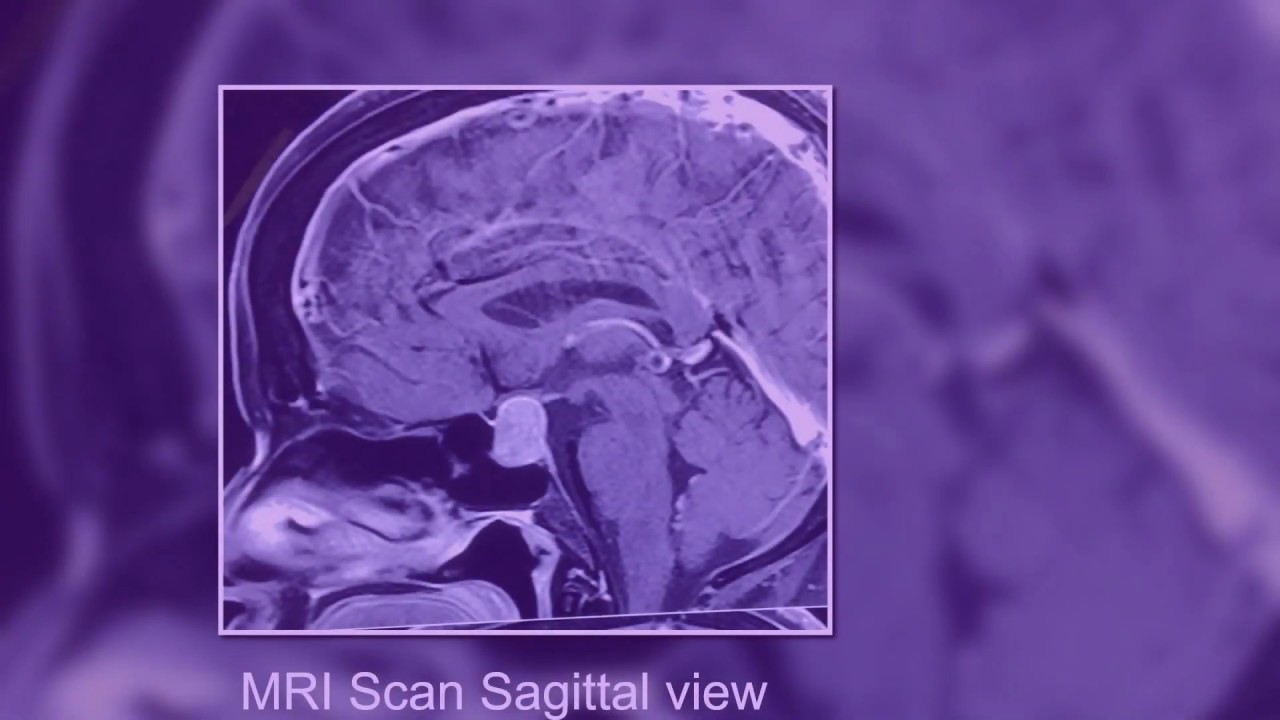 Endoscopic Transnasal Pituitary Surgery - YouTube