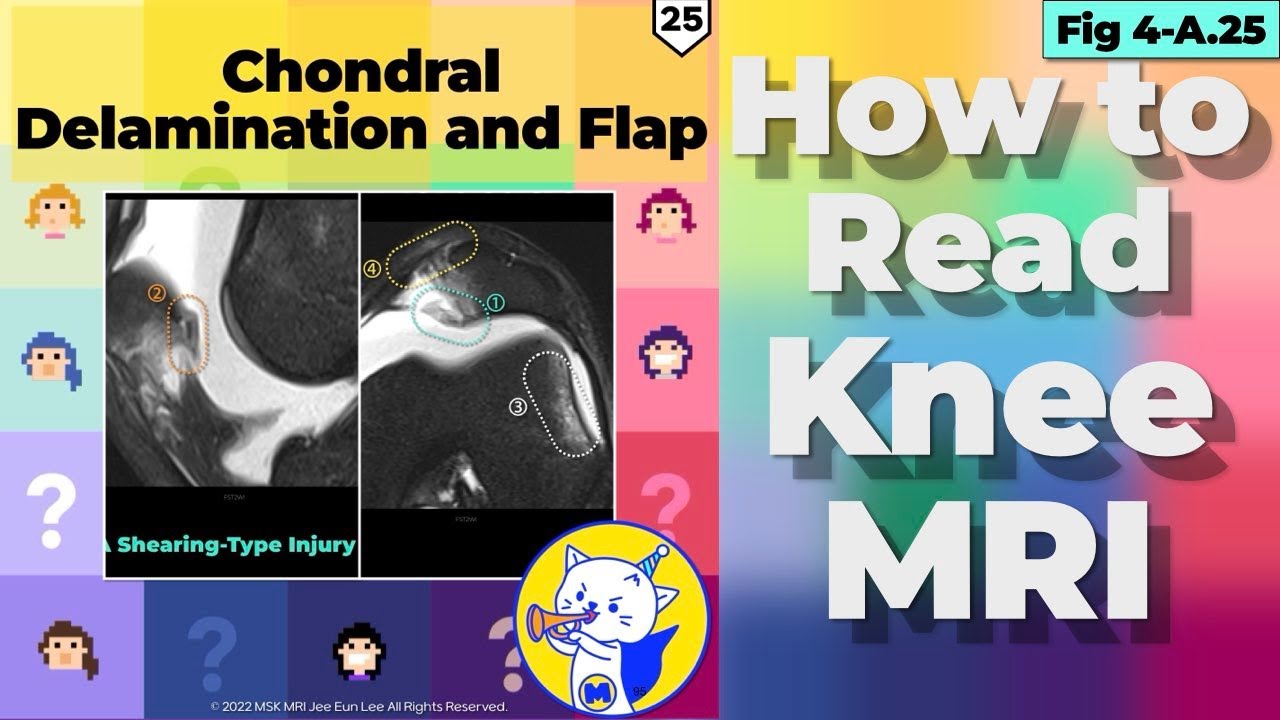 (Fig 4-A.25) Chondral Delamination and Flap in Patellar Dislocation ...