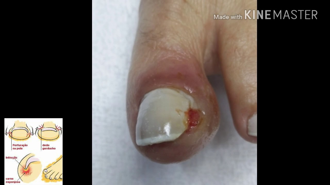 Onicocriptose - YouTube