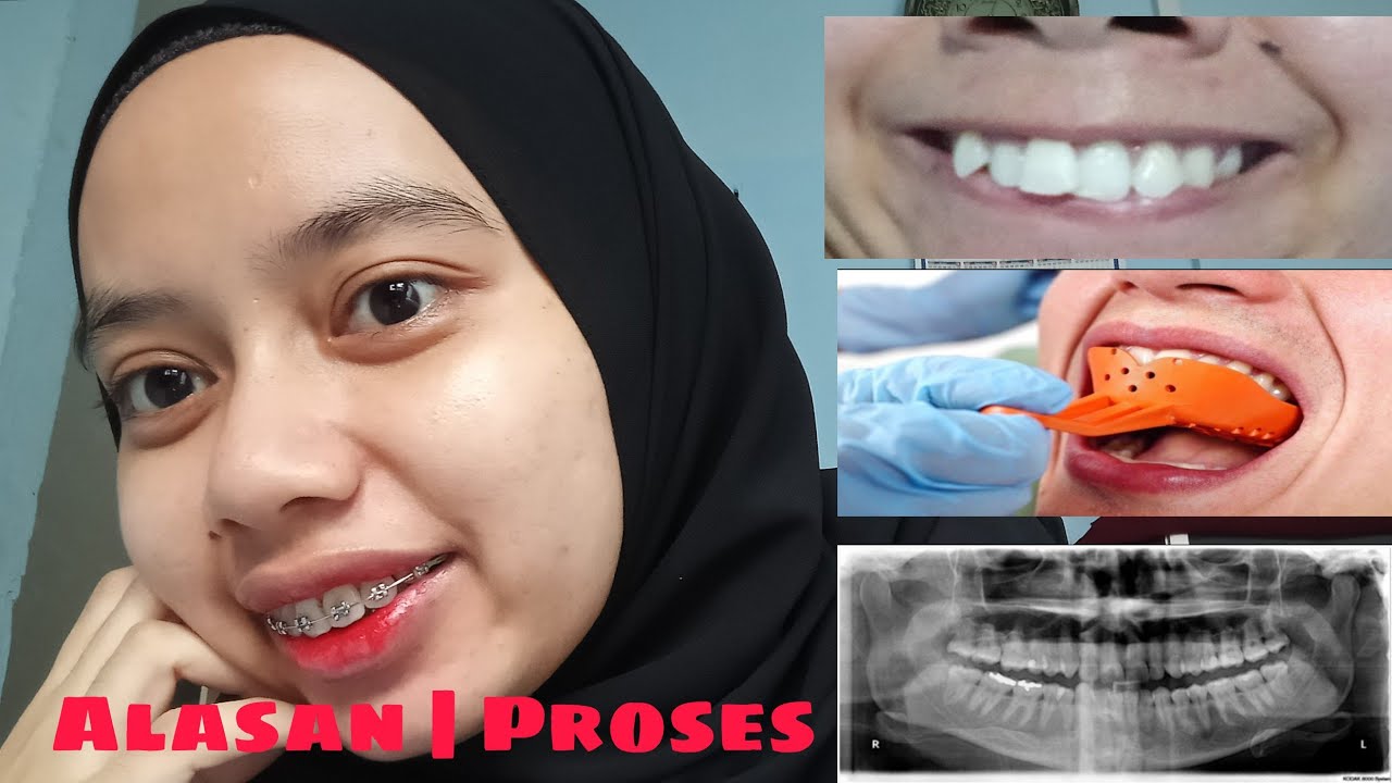 PENGALAMAN PAKAI BEHEL | ALASAN DAN PROSES - YouTube