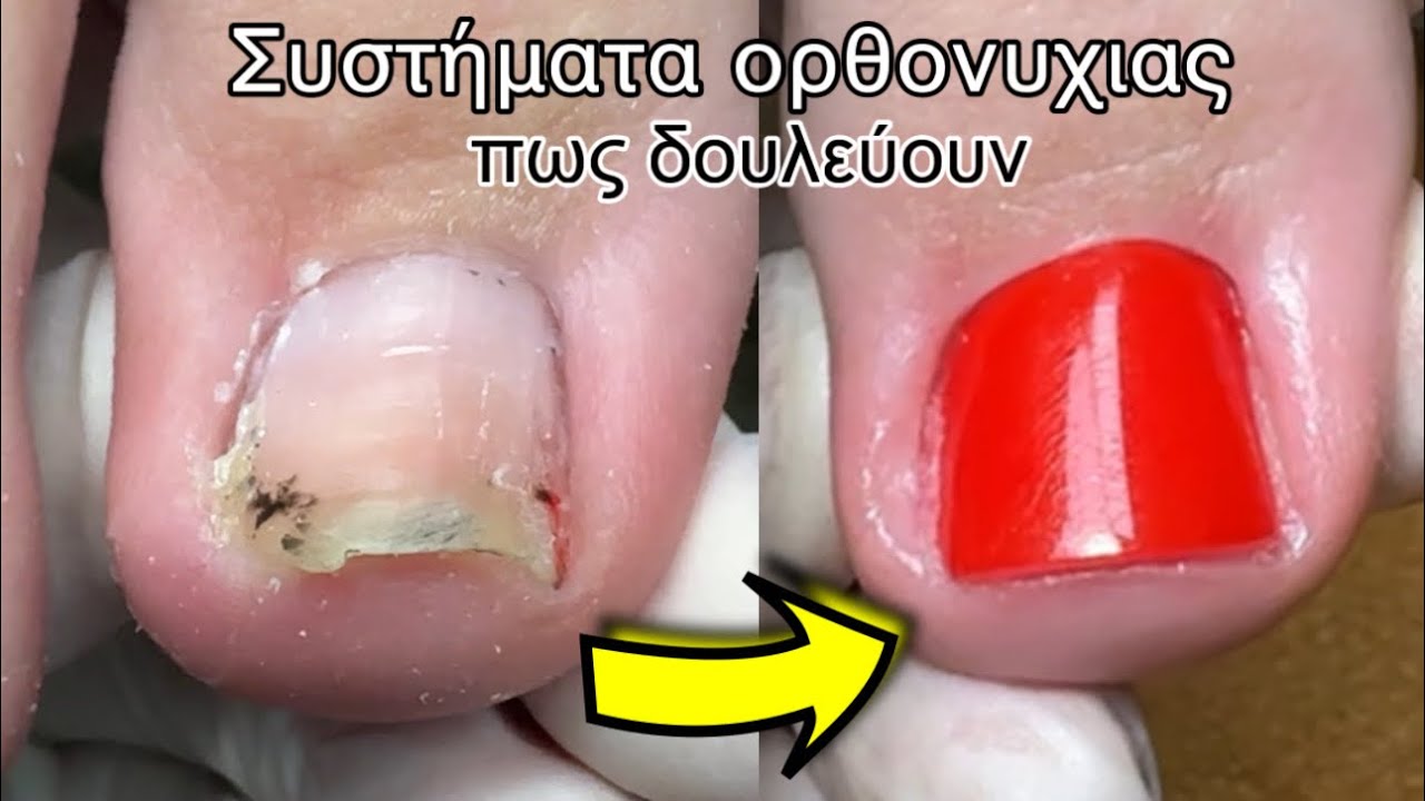 Σύστημα ορθονυχιας μέσα σε έναν μήνα/ Πως κινήθηκα για να έχω ...