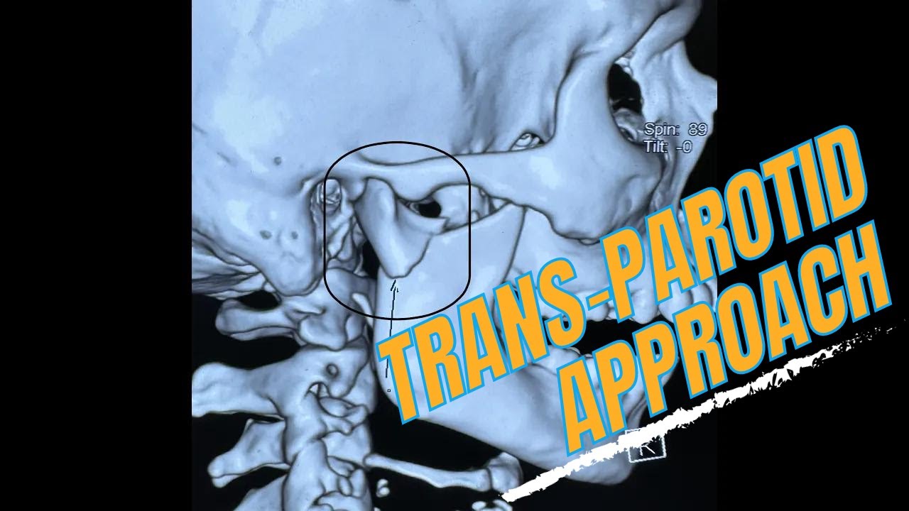 TRANSPAROTID APPROACH TO FRACTURED CONDYLE. | ORAL SURGERY - YouTube
