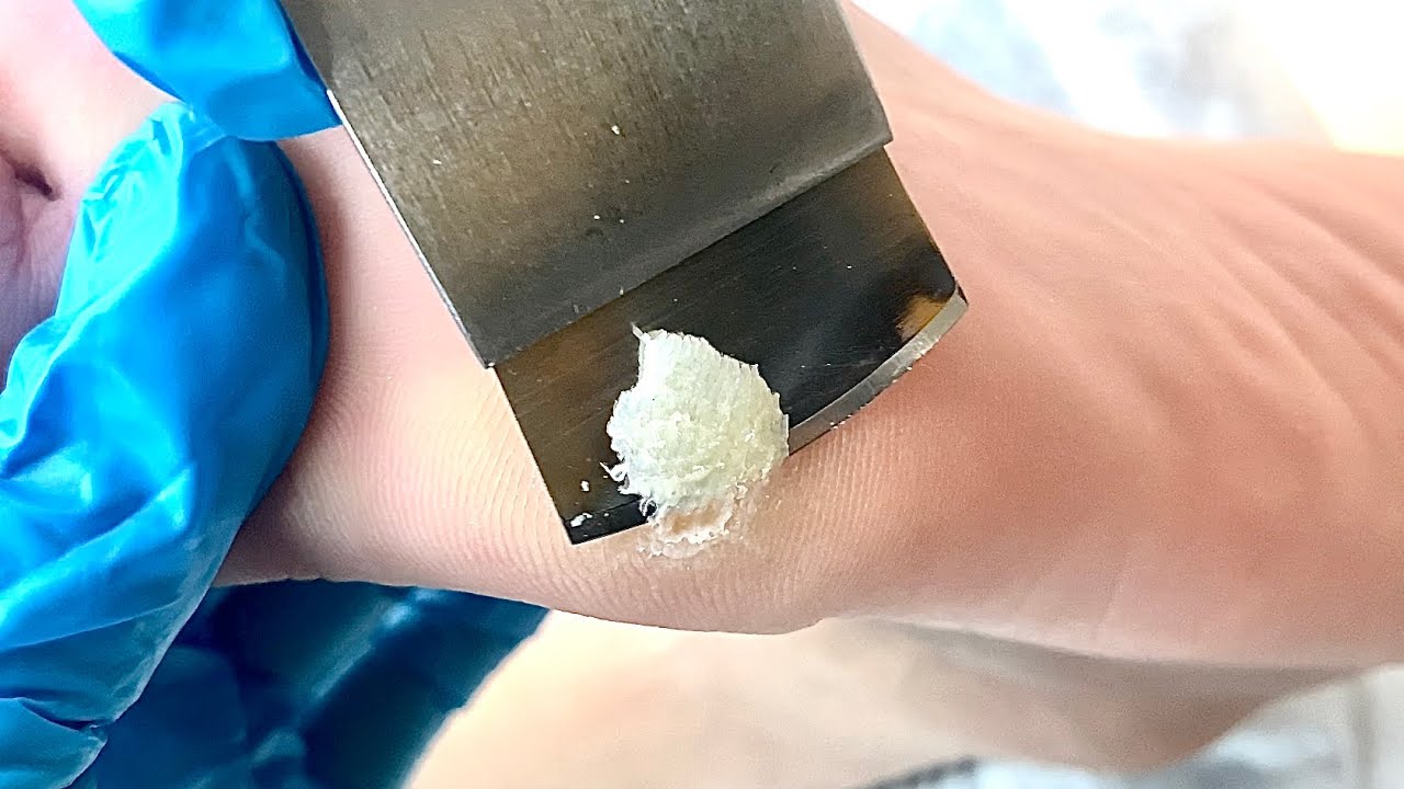 Callus removal from feet&Foot scraping dead skin【Xiao Yan pedicure】# ...