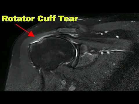 Rotator Cuff (supraspinatus) Tear - YouTube