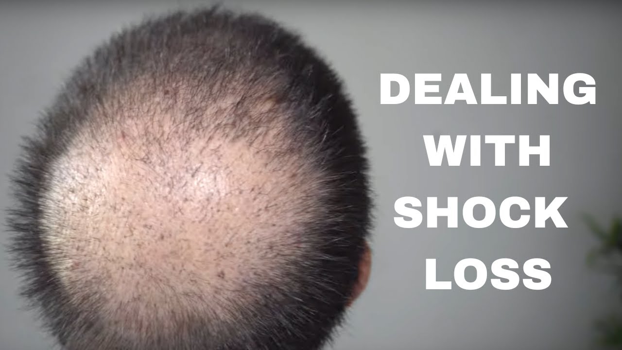 Shock Loss After a Hair Transplant (and how to deal with it) - YouTube